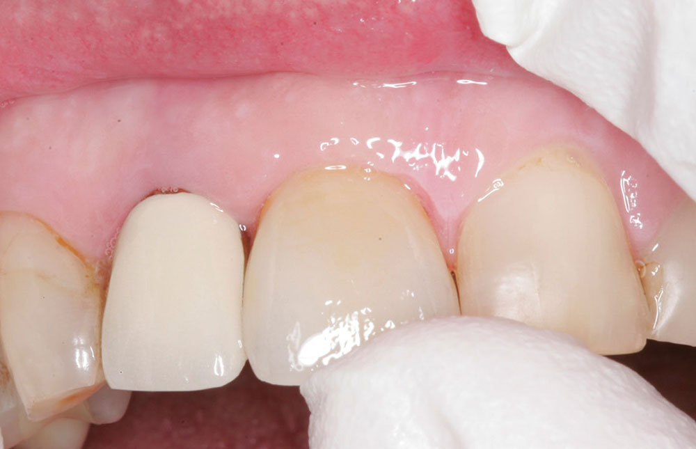 Simplifying Accurate Evaluation: Adjustment of Proximal Contacts
