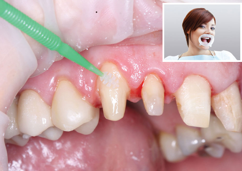 Ask Dr. Christensen Preventing Postoperative Tooth Sensitivity