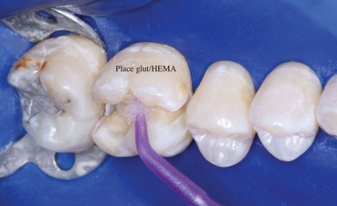 Ask Dr. Christensen Preventing Postoperative Tooth Sensitivity