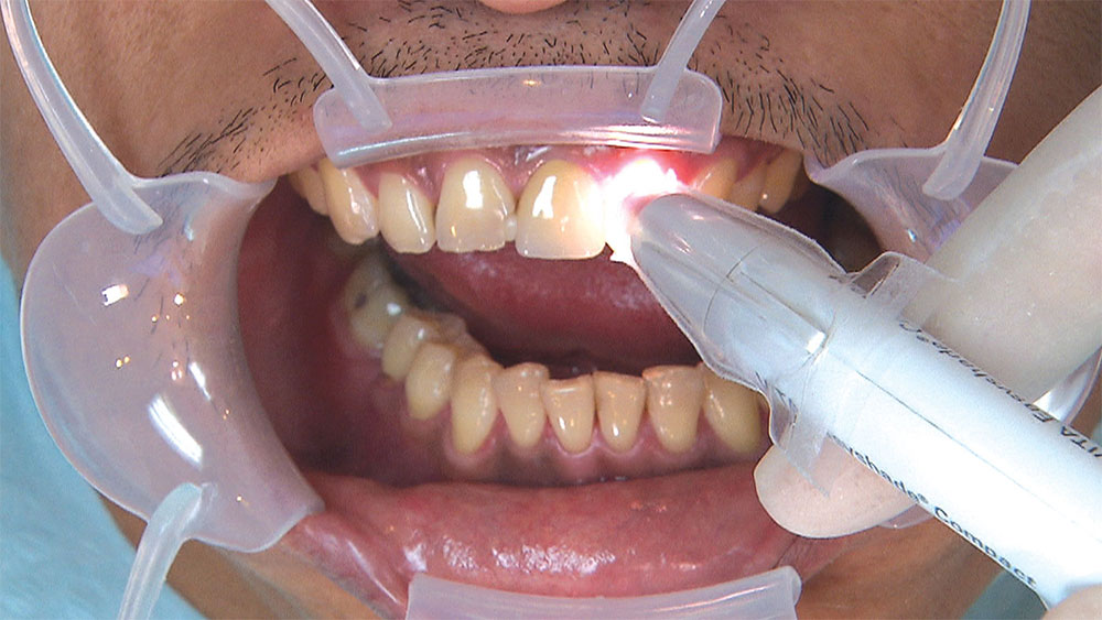 Photo Essay: Ensuring Adequate Reduction with the Reverse Preparation ...