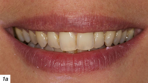 Versatility of Astron Occlusal Splints