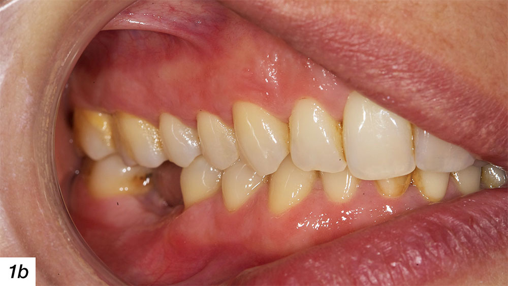 Versatility of Astron Occlusal Splints