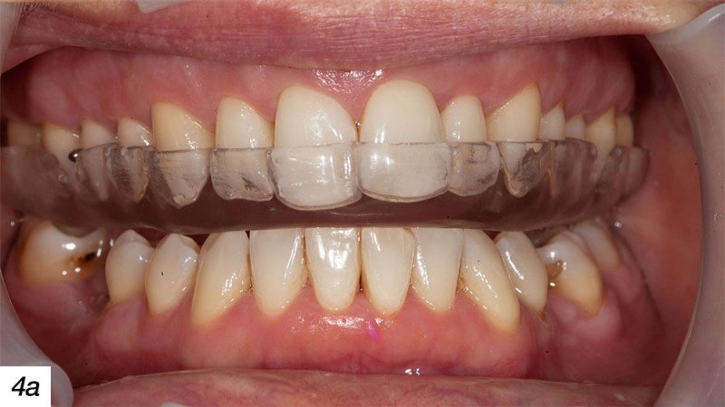 Versatility of Astron Occlusal Splints