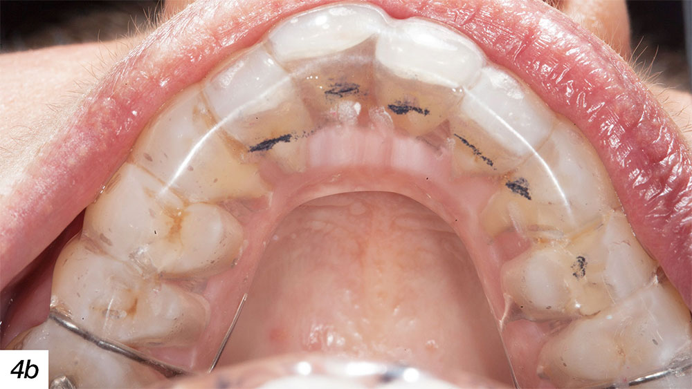 Versatility of Astron Occlusal Splints