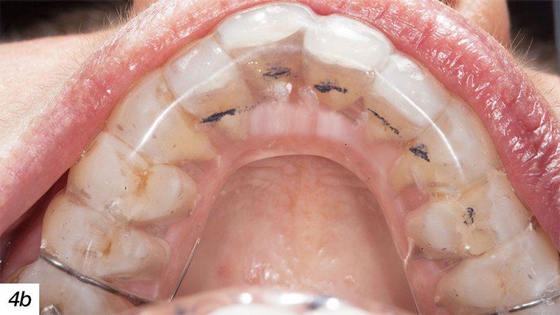 Versatility of Astron Occlusal Splints