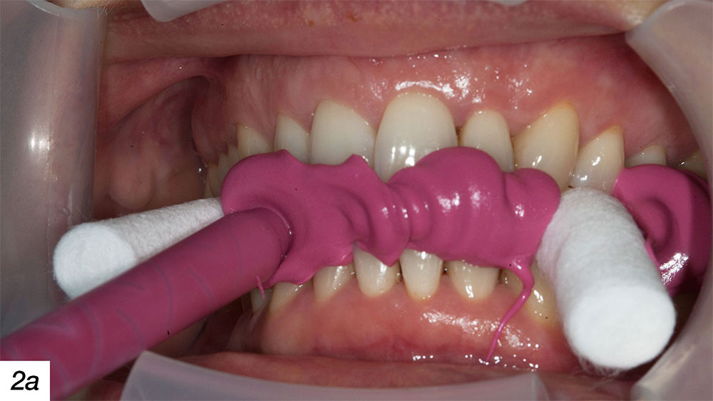 Versatility of Astron Occlusal Splints