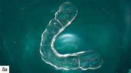 Versatility of Astron Occlusal Splints