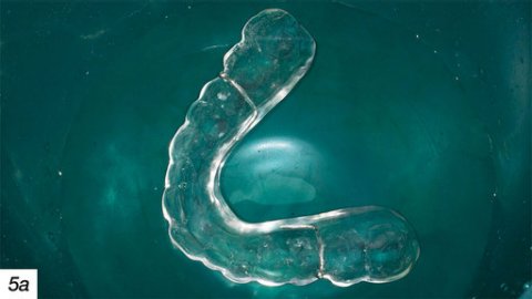 Versatility of Astron Occlusal Splints