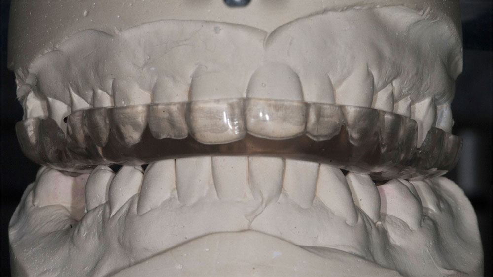 Versatility of Astron Occlusal Splints