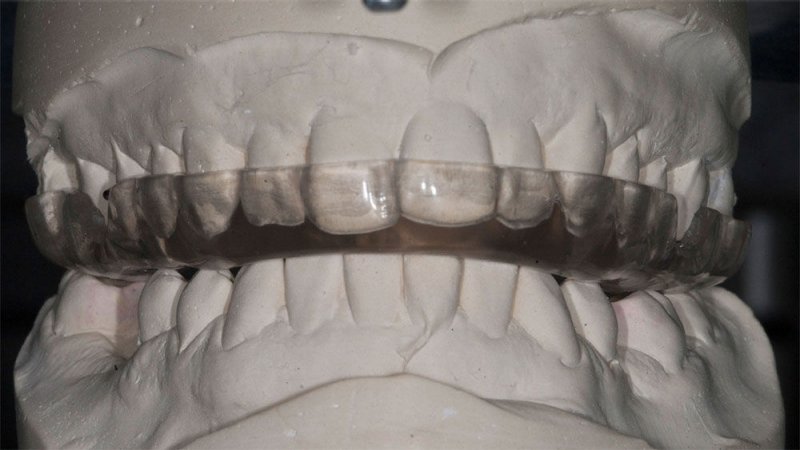 Versatility of Astron Occlusal Splints