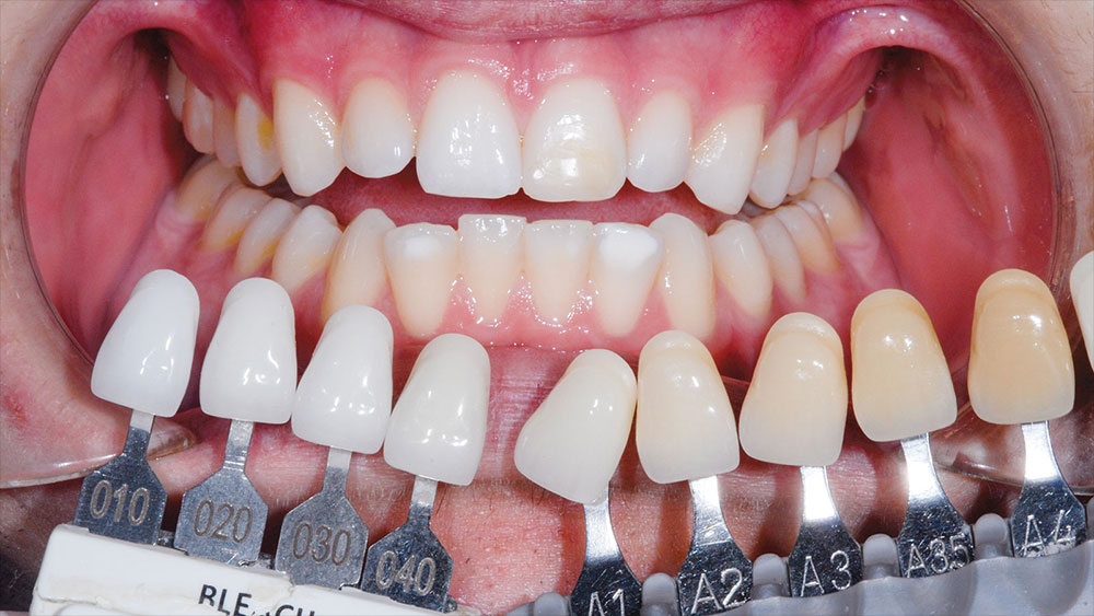 Foundation for a Successful Smile Makeover: Understanding Bleaching ...