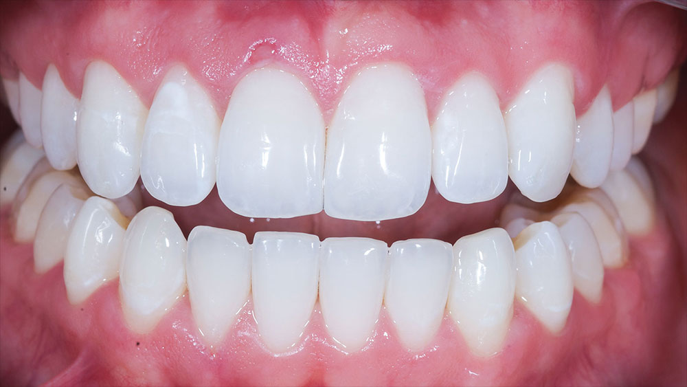Foundation for a Successful Smile Makeover: Understanding Bleaching ...