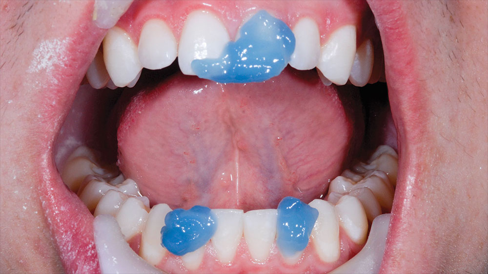 Foundation for a Successful Smile Makeover: Understanding Bleaching ...