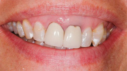 Getting the Lines Right