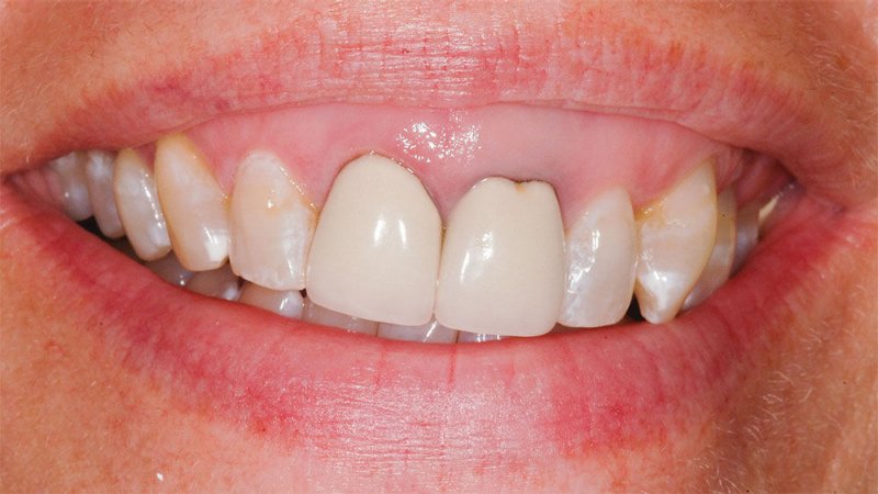 Getting the Lines Right