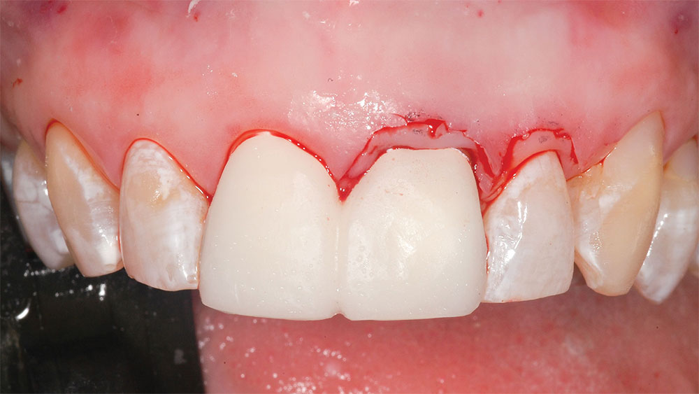 Getting the Lines Right