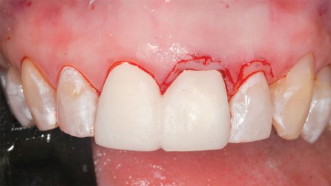 Getting the Lines Right