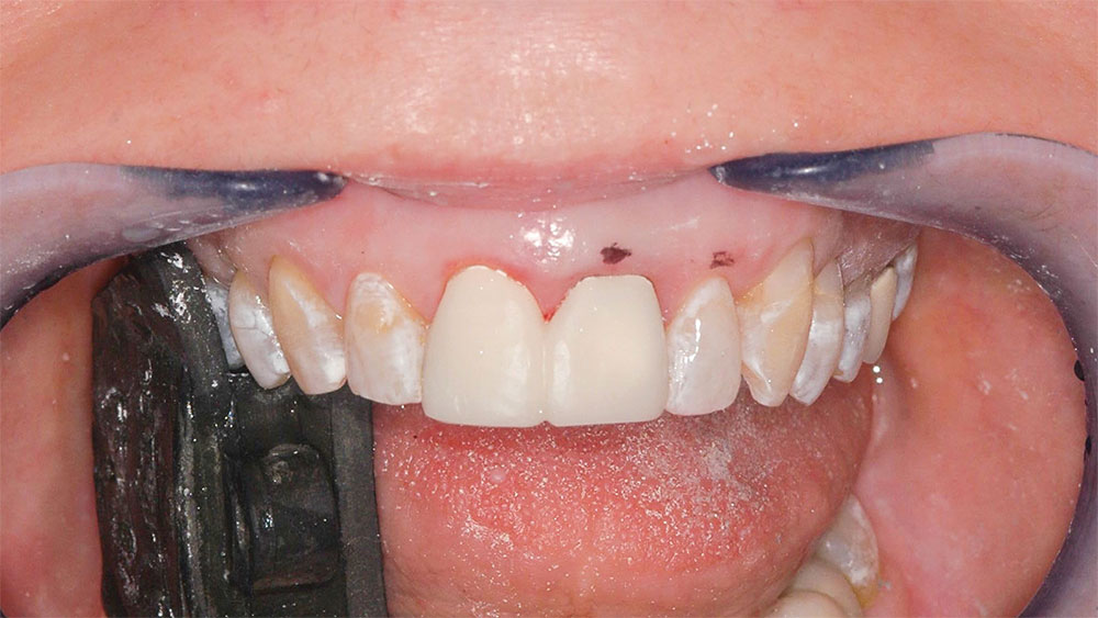 Getting the Lines Right