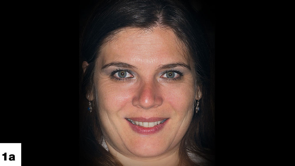 Photo Essay Providing Implant Treatment and Protecting Dentition with ...