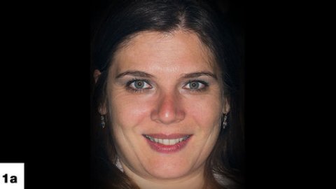 Photo Essay Providing Implant Treatment and Protecting Dentition with ...