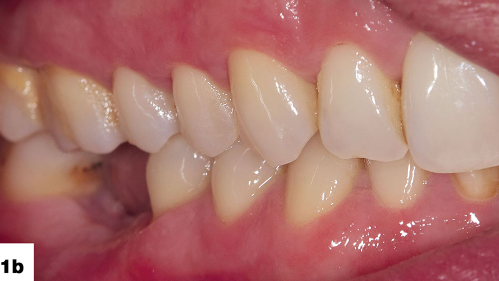 Photo Essay Providing Implant Treatment and Protecting Dentition with ...