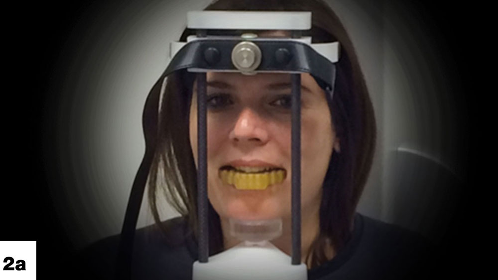 Photo Essay Providing Implant Treatment and Protecting Dentition with ...