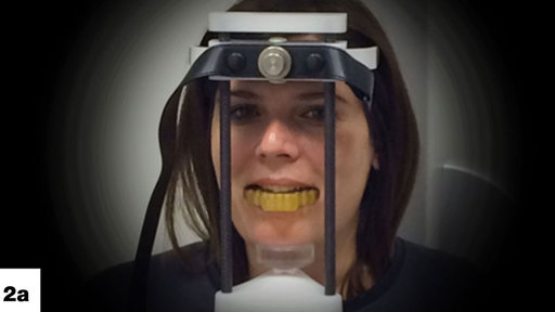 Photo Essay Providing Implant Treatment and Protecting Dentition with ...