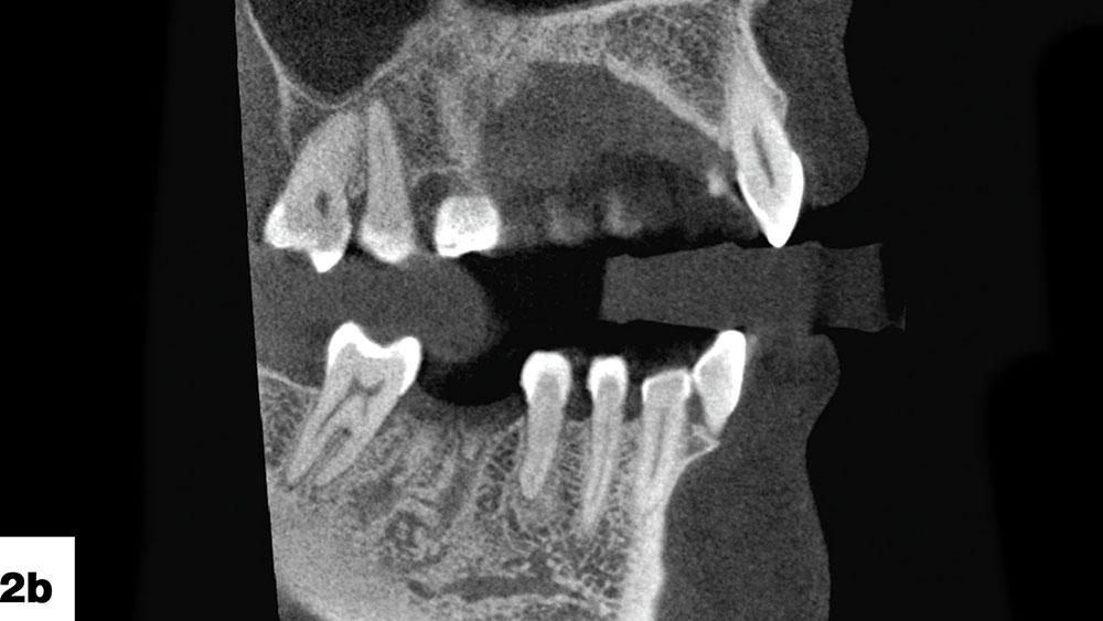 Photo Essay Providing Implant Treatment and Protecting Dentition with ...