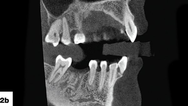 Photo Essay Providing Implant Treatment and Protecting Dentition with ...