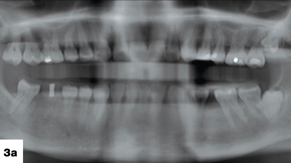 Photo Essay Providing Implant Treatment and Protecting Dentition with ...