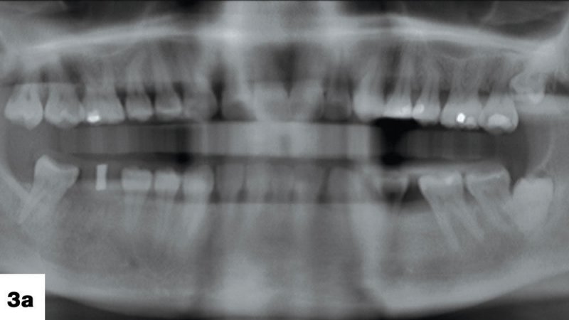 Photo Essay Providing Implant Treatment and Protecting Dentition with ...