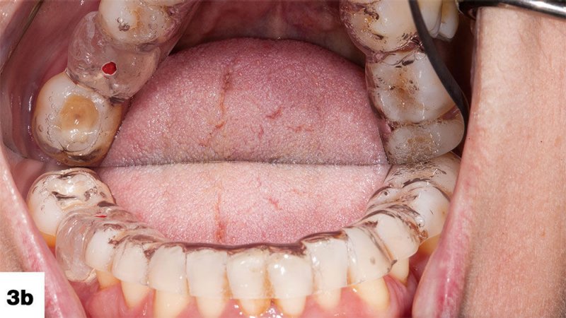 Photo Essay Providing Implant Treatment and Protecting Dentition with ...