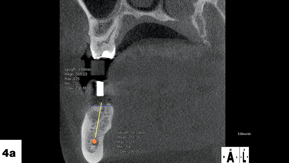 Photo Essay Providing Implant Treatment and Protecting Dentition with ...