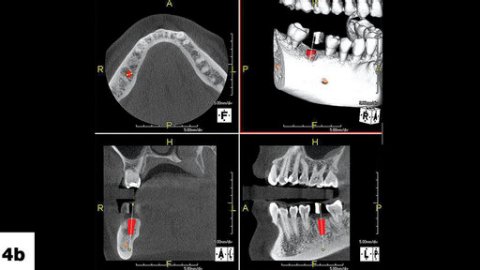 Photo Essay Providing Implant Treatment and Protecting Dentition with ...