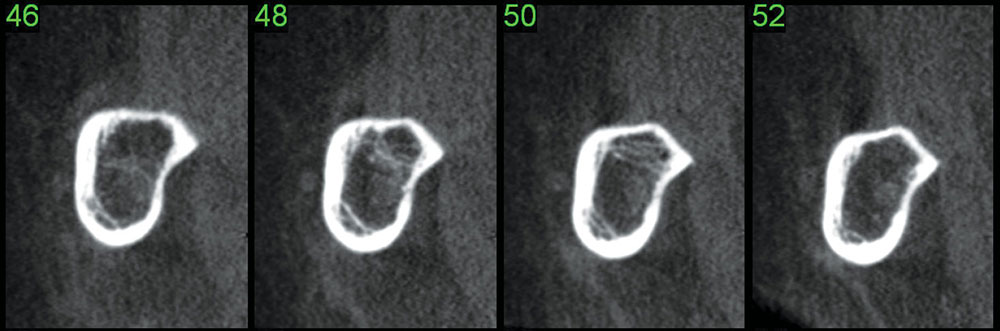 The Mylohyoid Ridges: Troublemakers Often Undiagnosed