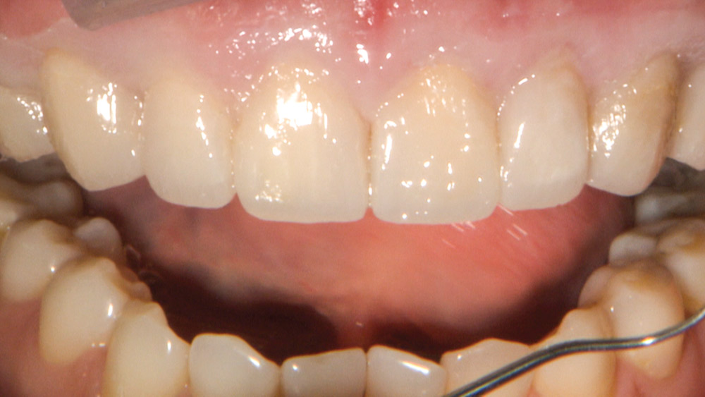Collaborating on a Smile Makeover – From Surgery to Obsidian® Veneers