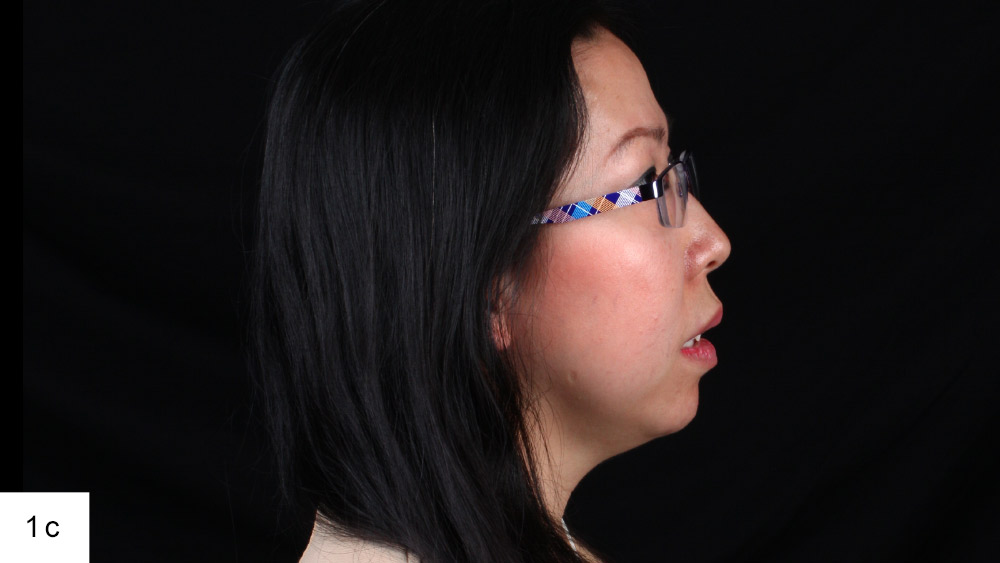 Collaborating on a Smile Makeover – From Surgery to Obsidian® Veneers