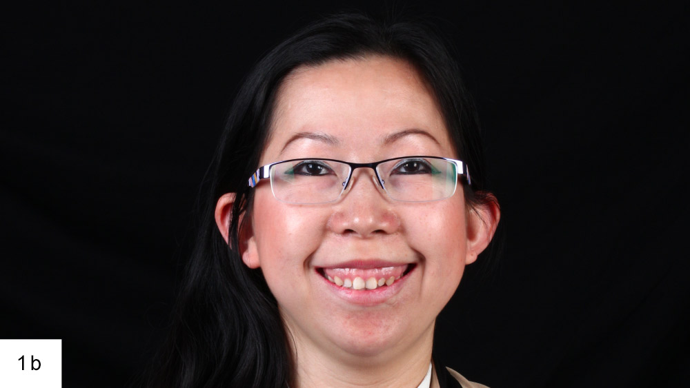 Collaborating on a Smile Makeover – From Surgery to Obsidian® Veneers