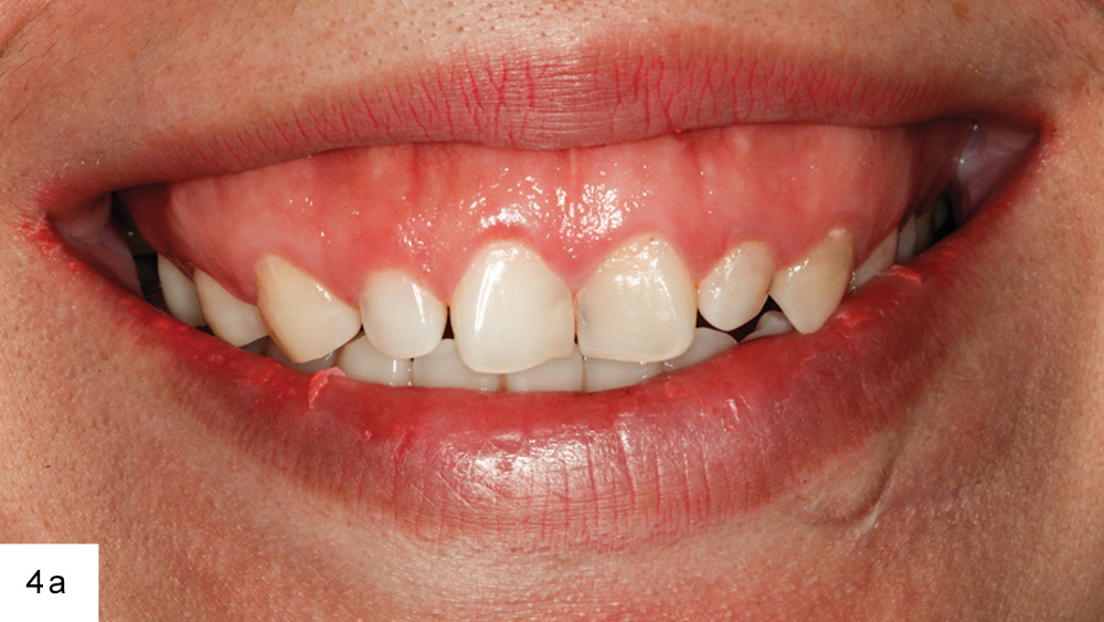 Collaborating on a Smile Makeover – From Surgery to Obsidian® Veneers