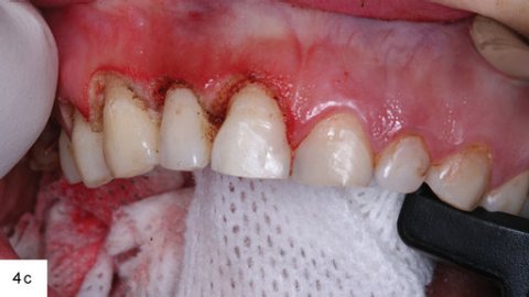 Collaborating on a Smile Makeover – From Surgery to Obsidian® Veneers