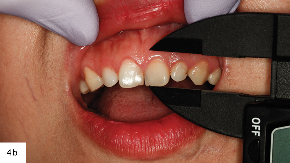 Collaborating on a Smile Makeover – From Surgery to Obsidian® Veneers