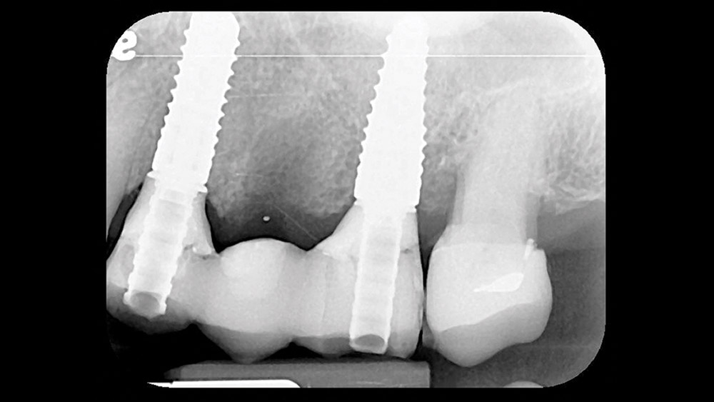 Digital Scanning of Implants: A Win-Win for GP, Specialist and Patient ...