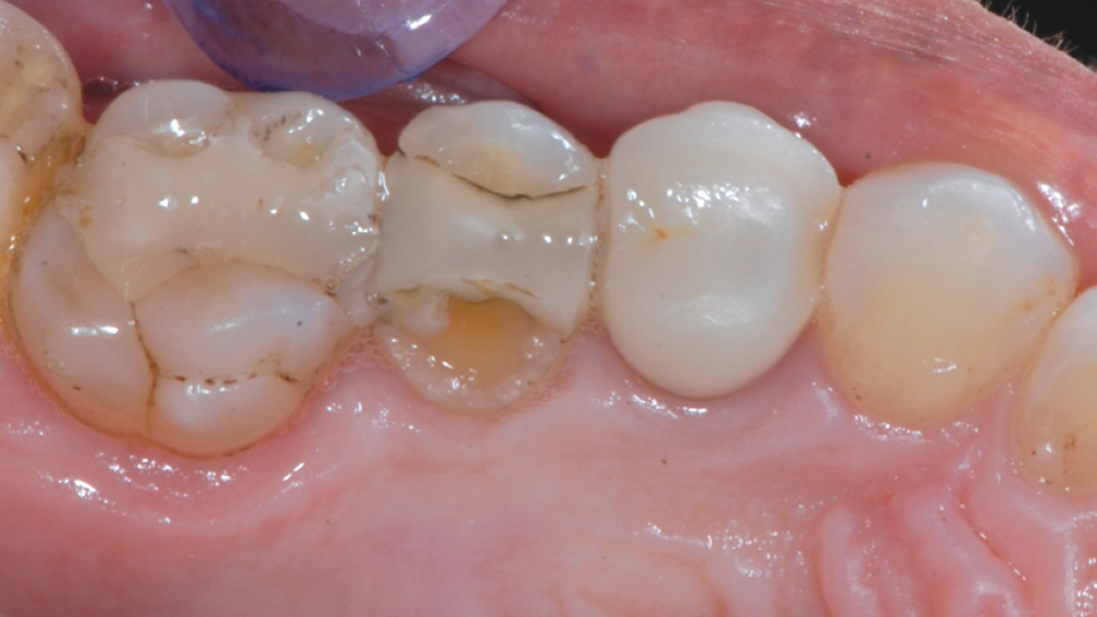 Practice Management – Accelerate Your Success with Chairside Milling