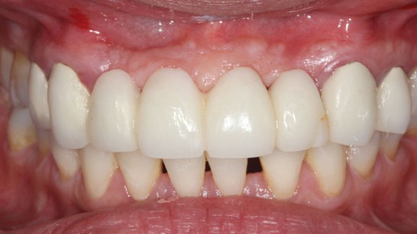 Utilizing a Digital Workflow for Provisionalization with BioTemps®