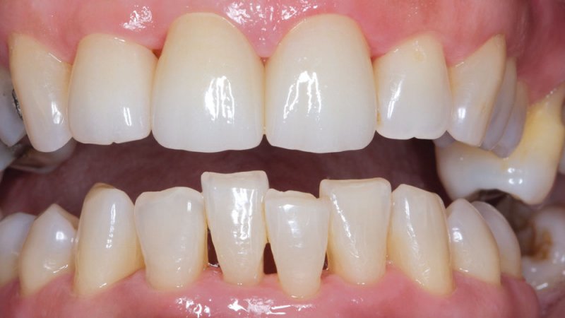 Restoring the Posterior with a BioTemps® Bridge – Case Of The Week ...