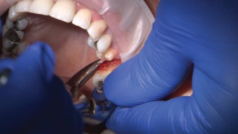 Restoring the Posterior with a BioTemps® Bridge – Case Of The Week ...