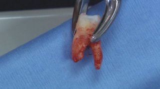 Restoring the Posterior with a BioTemps® Bridge – Case Of The Week ...