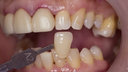 Restoring the Posterior with a BioTemps® Bridge – Case Of The Week ...
