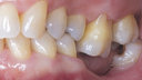 Restoring the Posterior with a BioTemps® Bridge – Case Of The Week ...