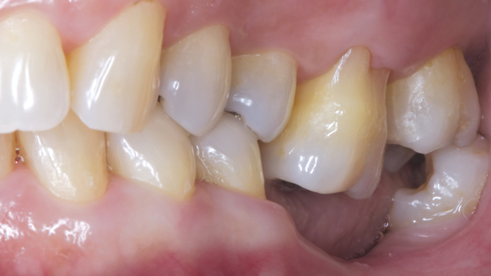 Restoring the Posterior with a BioTemps® Bridge – Case Of The Week ...